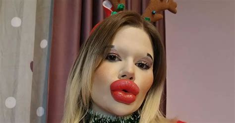 Woman With Worlds Biggest Lips Gets More Filler For Christmas