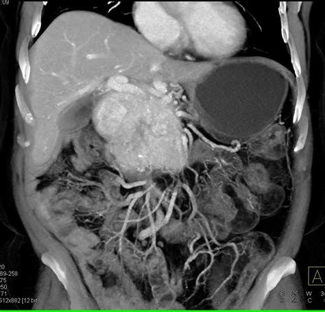 Neuroendocrine Tumor Pancreas Pancreas Case Studies Ctisus Ct Scanning