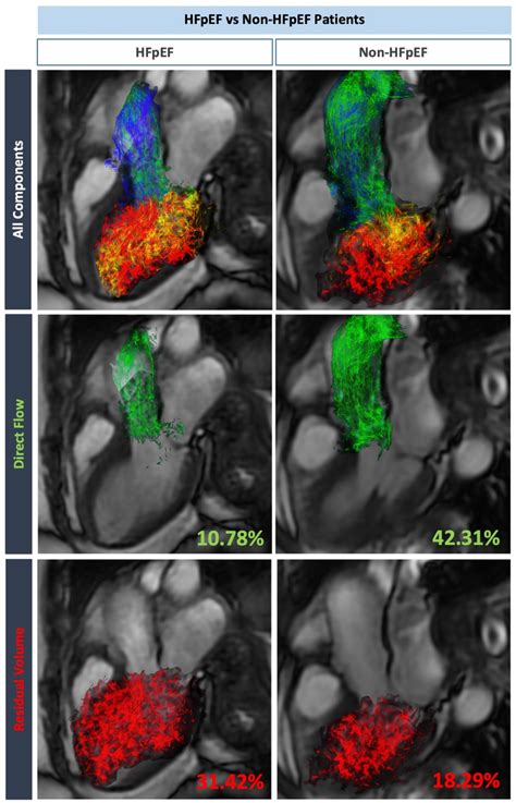 Comparison Of Direct Flow And Residual Volume In Hfpef And Non Hfpef