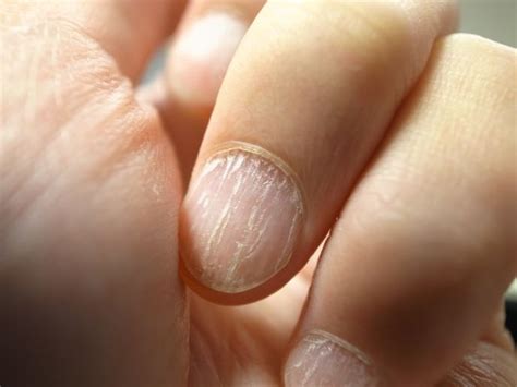 SAÚDE RESPONDE Tirei o esmalte e havia manchas brancas na unha O que pode ser