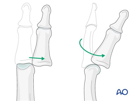Dislocation And Fracture Dislocation Of The Proximal Interphalangeal Joint