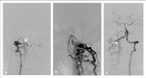 Figure 2 From Endovascular Treatment Of V3 Segment Vertebro Vertebral Arteriovenous Fistula With