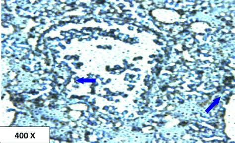 Immunostaining Of P53 In Nuclei Of Lung Tissues Using Lsab Method