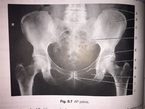 RT 10 Ch 8 AP Pelvis Radiograph Diagram Quizlet
