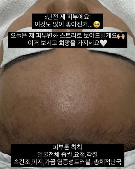 슈퍼젝션 해외전문 Japan K Beauty Skincare 스킨챕터 대표 박성아 저는 모태꿀피부가 아니에요 20살부터 시작된 여드름으로 불과 몇년전까지만해도