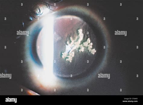 Dendritic Keratitis Hi Res Stock Photography And Images Alamy