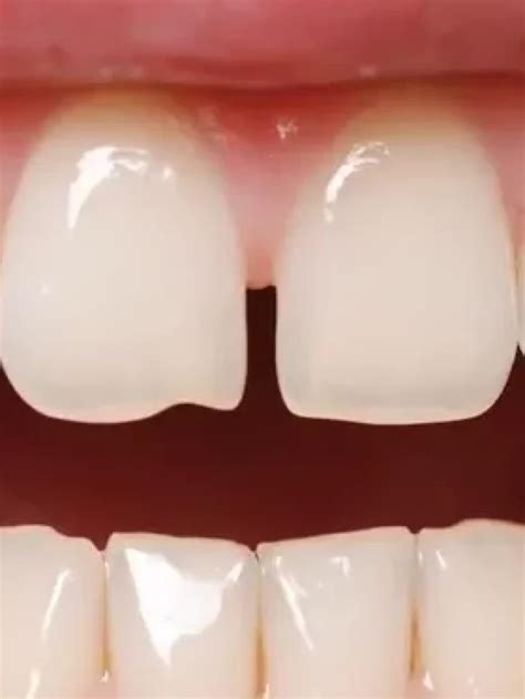 Gap Between The Teeth Diastema 3 Most Common Reasons World Of