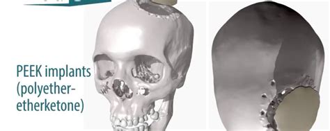 Patient Specific PEEK Implant After Titanium Explant