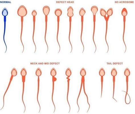 Varicocelerecovery Healvaricocele Nosurgery Maleinfertility