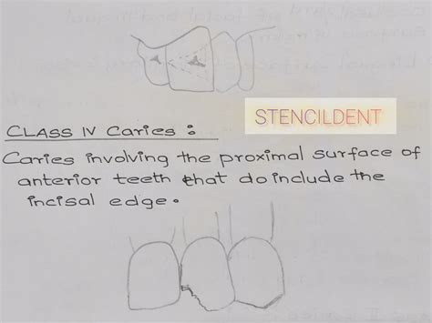 Dental Caries Defintion Gv Blacks Classification Caries Classification