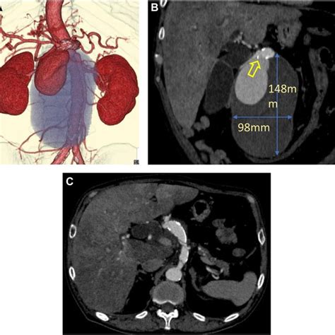 Preoperative Computed Tomography Ct Angiography Cta A