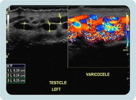 Causes And Treament Of Varicocele Georgiadis Urology