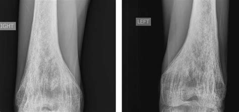 Osteopenia Symptoms Risk Factors And Causes
