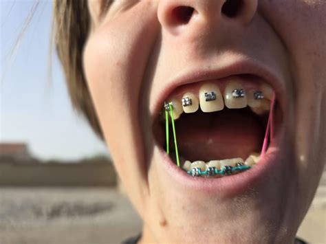 My Sons Braces Rcosmoandwanda