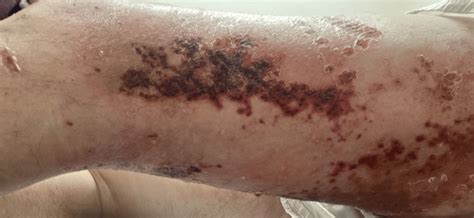 Toxic Erythema Of Chemotherapy Vasculitic Eruption With Malignant
