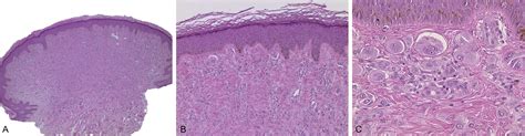 Eruptive Disseminated Spitz Nevi Case Report Anais Brasileiros De
