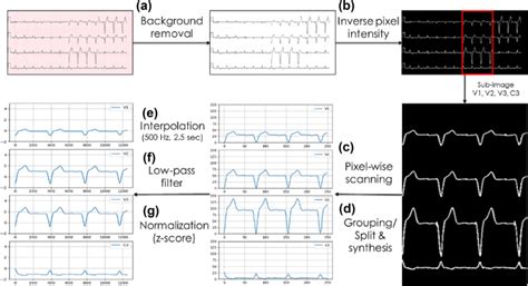 an artificial intelligence enabled ecg algorithm for identifying
