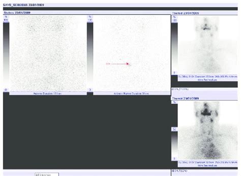 Radionuclide Scan Of The Thyroid Showing No Uptake Activity Download Scientific Diagram