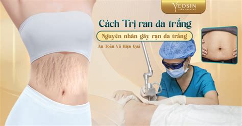 Rạn trắng Cách trị rạn da màu trắng an toàn và hiệu quả