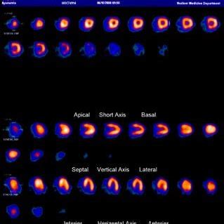 Myocardial Perfusion Scan A Prior To Percutaneous Coronary Download Scientific Diagram