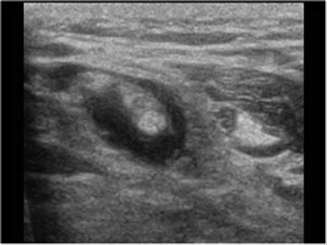 Musculoskeletal Joints And Tendons 66 Knee Case 6613 Medial Side