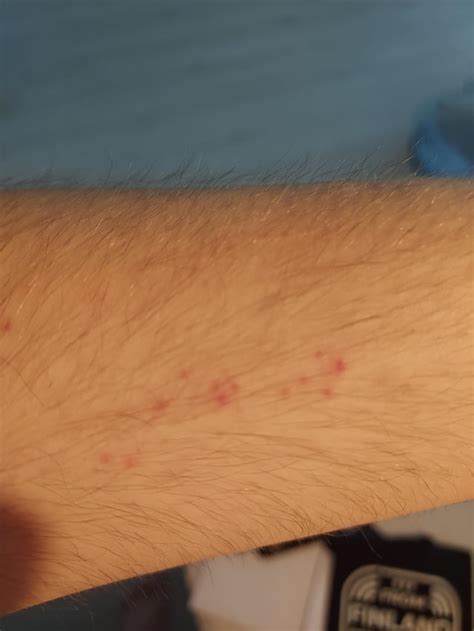 Are These Bed Bug Marks Rbedbugs
