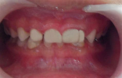 Figure 2 From Management Of Three Fused Primary Teeth Semantic Scholar