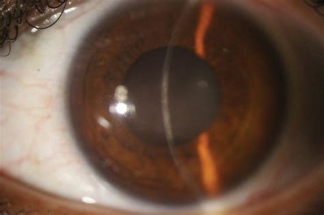 Slit Lamp Anterior Segment Image Indicating Central Corneal Opacity