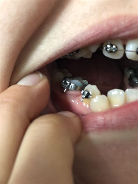 Gingival Hyperplasia With Braces