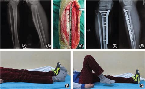 Tibial Osteosarcoma Modified Score System Mss 6 Treated With Download Scientific Diagram
