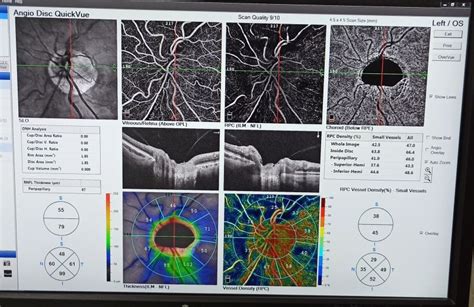 Mohammad Daraei On Linkedin Oct Octa Optovue Peripapillary Atrophy Ppa Eye Retina Retinal…