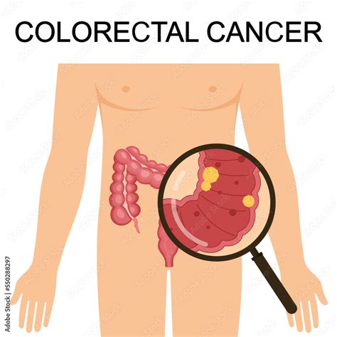 Colorectal Canser CRC Vector Illustration Colon Canser Medical