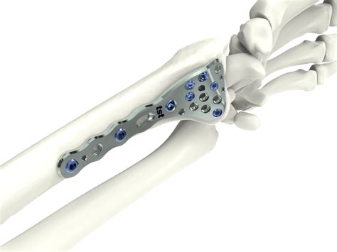 Distal Radius Plate Volar Tst