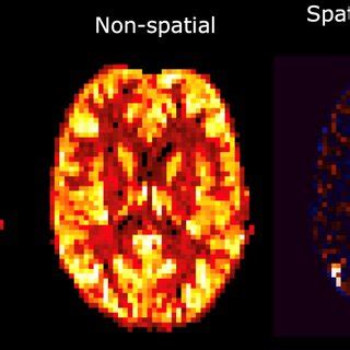 Perfusion Maps Derived From Single Delay Pseudo Continuous ASL With