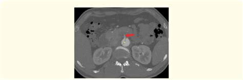 Stanford Type B Aortic Dissection Axial CT Angiography Image