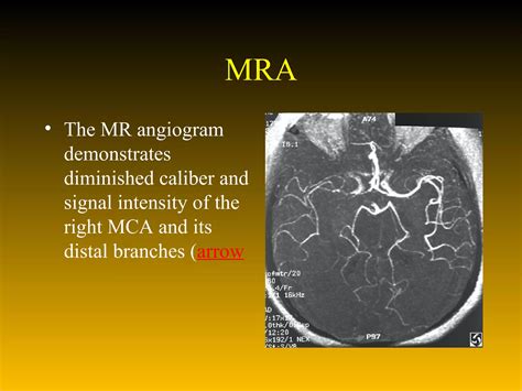 Acute Infarction Cerebral Ppt