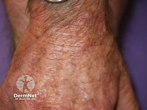 Generalised Eruptive Keratoacanthoma Images — Dermnet