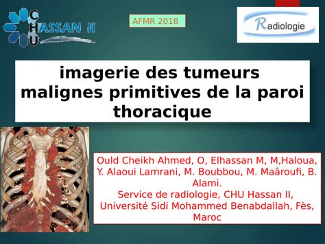 PDF Imagerie Des Tumeurs Malignes Primitives De La Paroi Thoracique