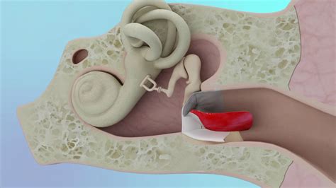 Eardrum Hole Repair Animation Youtube