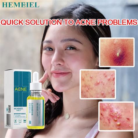 HEMEIEL Pimples Acne Remover Best Seller Benzoyl Peroxide For Acne Acne Remover Serum