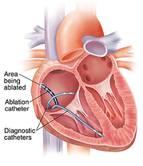 Electrophysiology Study And Catheter Ablation Universal Hospital
