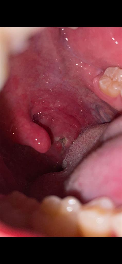Tonsil Stones Raskdoctorsmeeee