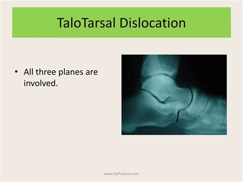 Talotarsal Dislocation Radiographic Evidence Pptx