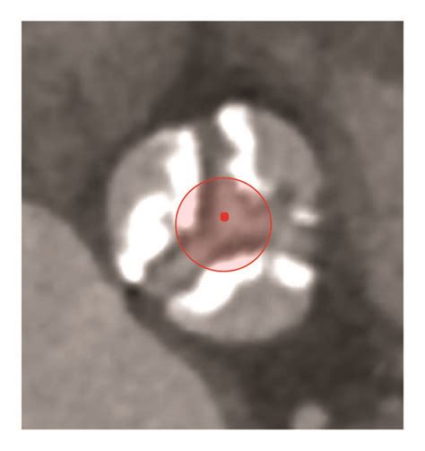 Ct Imaging Of Aortic Valves With Different Degree Of Calcification Download Scientific Diagram