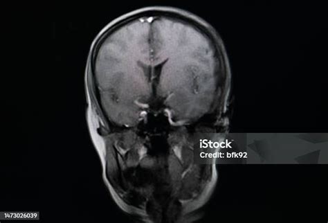 Brain Mri Scan Scanning Of Brains Magnetic Resonance Image Diagnostic