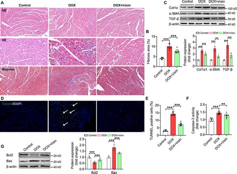 Irisin Mitigates Doxorubicin Induced Cardiotoxicity By Reducing Oxidat DDDT