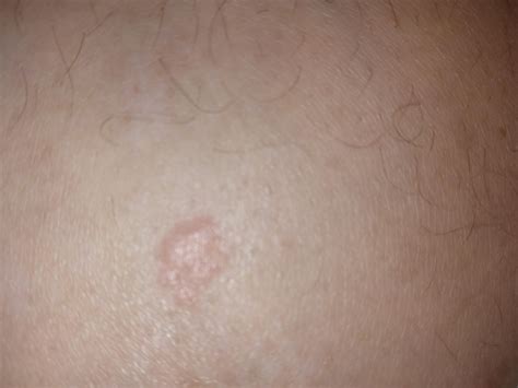 Maybe Not Scabies Maybe Another Mite Like The Clover Mite The Cdc And