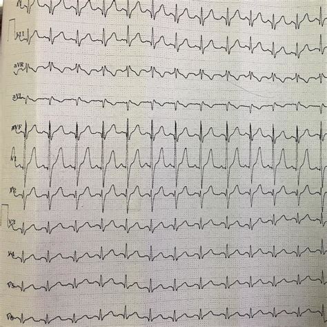 Patient Ecg Showing Extreme Counterclockwise Rotation Of The Heart And