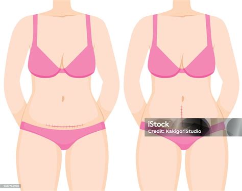 C Section Cesarean Operation Stock Illustration Download Image Now