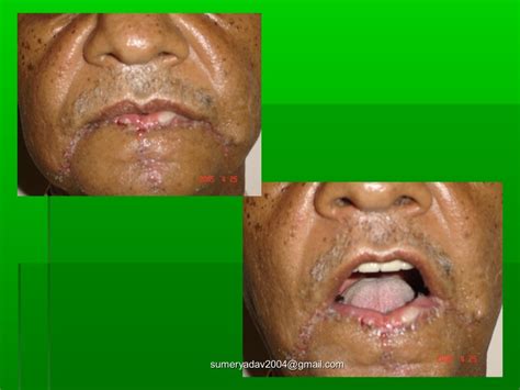 Lip Reconstruction